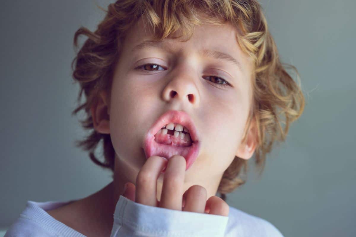 The Importance Of Emergency Dental Care For Broken Teeth